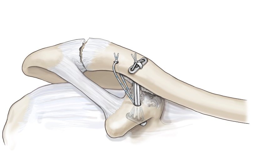 AC joint reconstruction – Malleshwara Orthopaedic Centre and Polyclinic